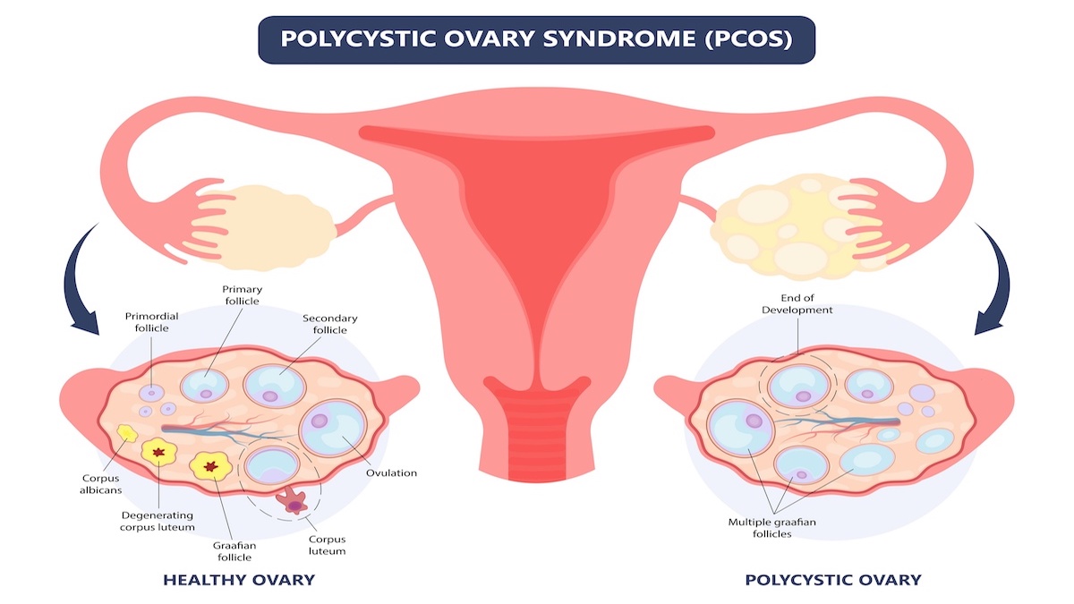 What Is PCOS and How Can a Vegan Diet Help Combat Symptoms - Form - US