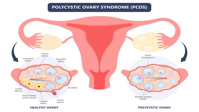 What Is PCOS and How Can a Vegan Diet Help Combat Symptoms - Form